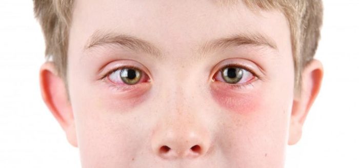 Which Type of Pink Eye Does My Child Have? - Witlin Center for Advanced ...